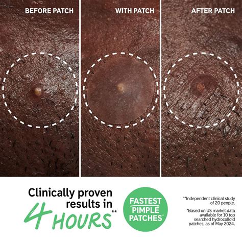 The Inkey List Hydrocolloid Invisible Pimple Patches International Shipping