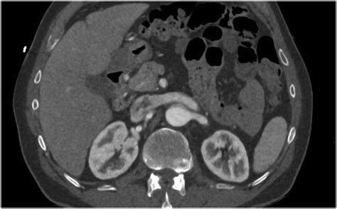 Dynamic And Static Vessel Malperfusion As A Consequence Of Acute Type B