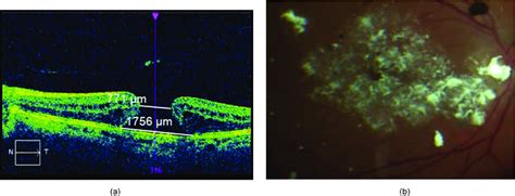 A Oct Patient Pre Operation Patient А B Contrasting By Download Scientific Diagram