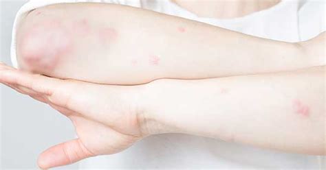 Psoriasis Eritrodérmica ¿qué Es Y Cuáles Son Sus Síntomas