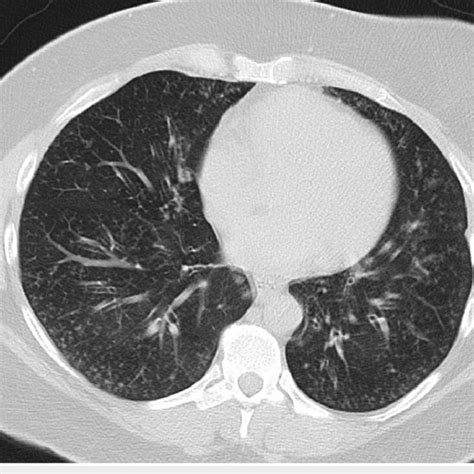 Axial CT Image Showing Multiple Bilateral Centrilobular And Tree In Bud Download Scientific