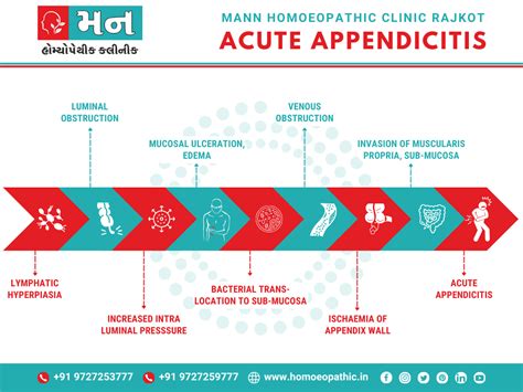 Appendicitis Mann Homeopathy Clinic Rajkot