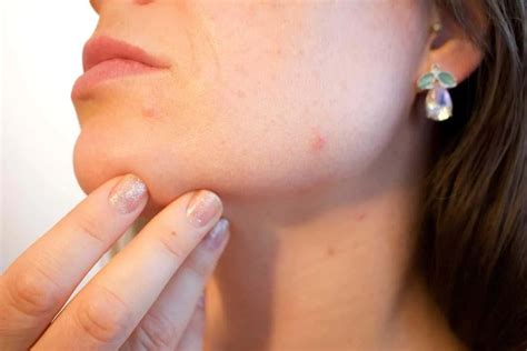 Varicela Cauze Simptome Tratament Dr Max Farmacia