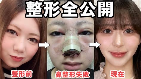 【写真付き】今までやった整形を全て教えます。鼻整形失敗、修正手術、傷跡や後遺症についても暴露する。 Youtube