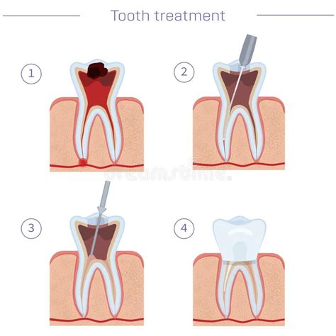 Tooth Treatment Step By Step Instructions Hemisection Root Removal