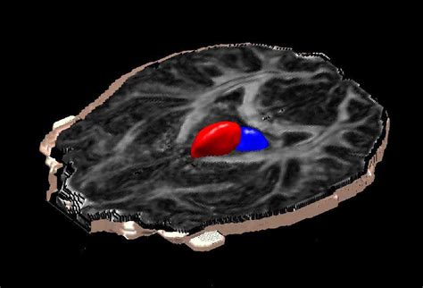 Figure 76 From Segmentation Of Diffusion Weighted Mri Using The Level Set Framework Semantic
