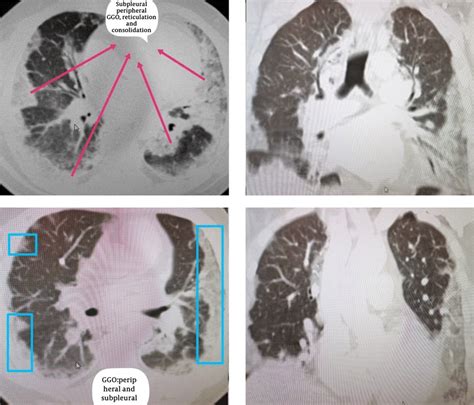 An Axial Ct Image Obtained Without Intravenous Contrast In A Download Scientific Diagram