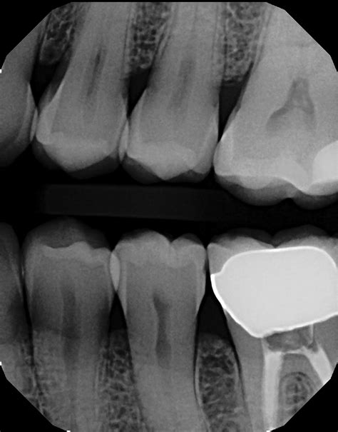 Ward Figure 18 Bite Wing Radiographic Image Oral Health Group
