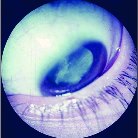 A Toxocara Peripheral Granuloma With Traction Fibrotic Band Extending Download Scientific