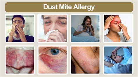 7 Dust Mite Allergy Symptoms You Shouldnt Ignore