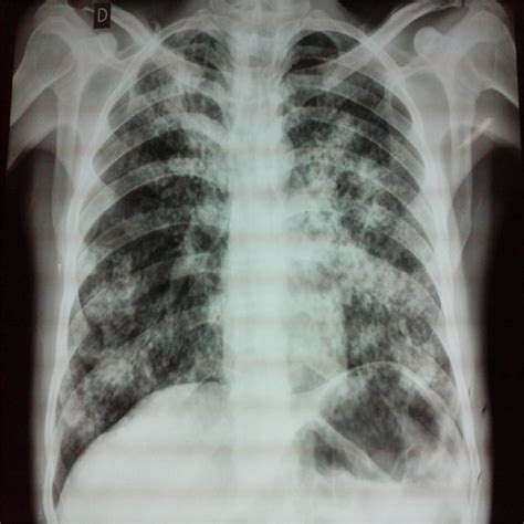Pdf Disseminated Pulmonary Histoplasmosis With Multiple Cutaneous