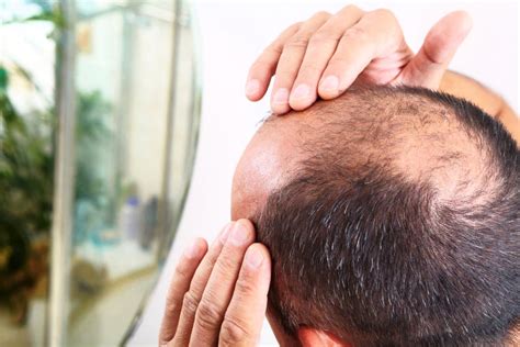 Male Pattern Baldness Causes Stages And Treatments