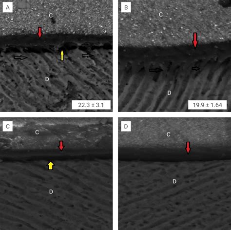 Sem Image 3000x Showing Tooth Restoration Interface After One Year Download Scientific Diagram