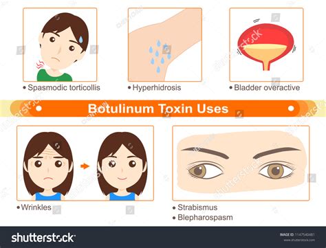 Botulinum Toxin Uses Stock Illustration 1147540481 Shutterstock