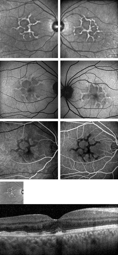 Reticular Pattern Dystrophy Of The Retina A Spectral Domain Optical Coherence Tomography Reticular Pattern Dystrophy Of The Retina A Spectral Domain Optical Coherence Tomography