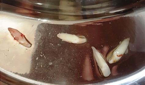 Case Ii Pre Operative Photographs Of An 18 Year Old Woman With Download Scientific Diagram