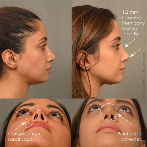 Nose Lifting Rhinoplasty Progression Nose Before And After