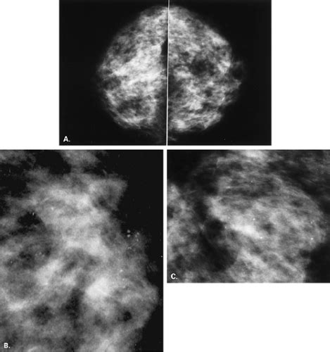 Analysis Of Calcifications Oncohema Key