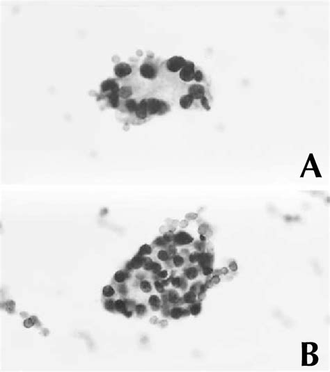 Thyroid Gland Macrofollicular Adenoma Semantic Scholar