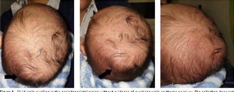 Figure 1 From Delayed Subaponeurotic Fluid Collection An Unusual Cause Of Scalp Swelling