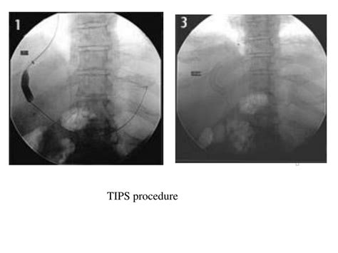 Ppt Interventional Radiology Powerpoint Presentation Free Download