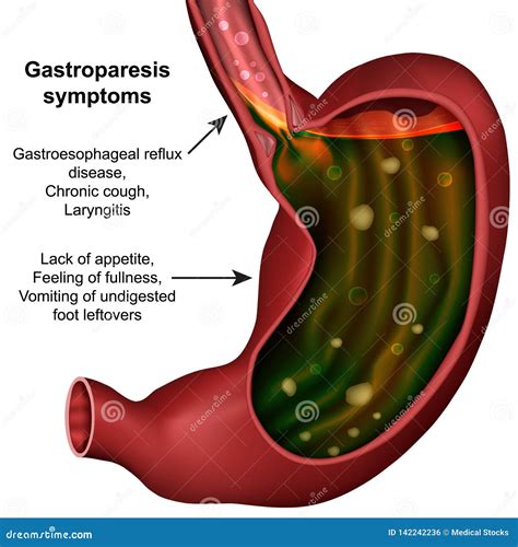 Gastroparesis Stomach Medical Illustration On White Background Royalty