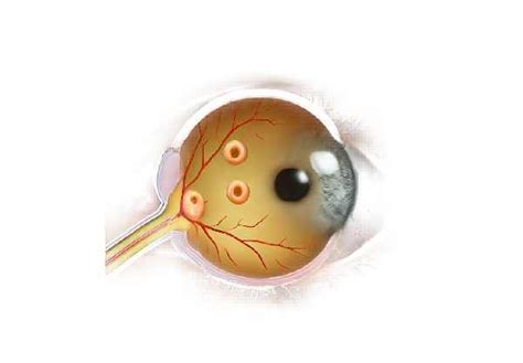 Limbal Stem Cell Deficiency Comprehensive Guide Vitalibrary