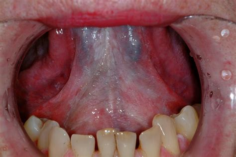 Oral Cavity Cancer Symptoms Causes Prevention Treatment Santenews