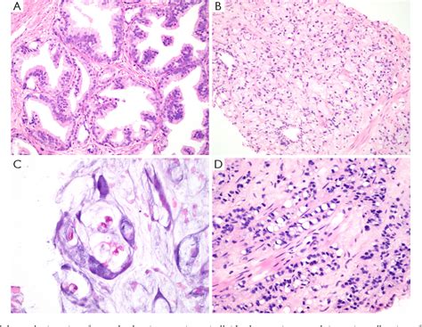 Figure 1 From The Pathology Of Unusual Subtypes Of Prostate Cancer