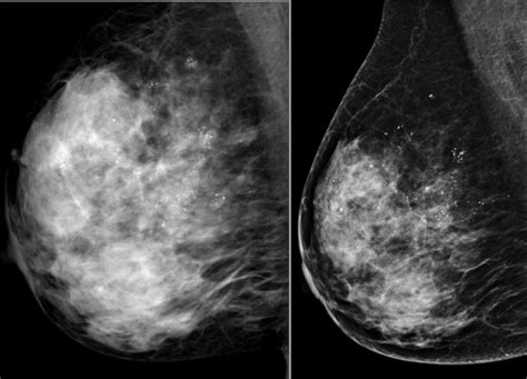 Breast Cancer Digital Mammogram