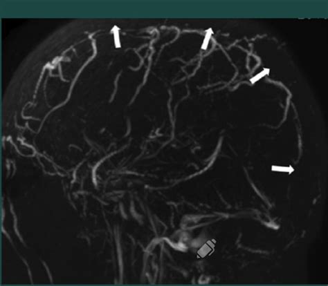Neuro Eye Neuroimaging Of The Orbit And The Head Part 1 Flashcards