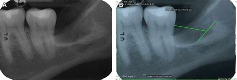 What Are The Types And Frequencies Of Complications Associated With