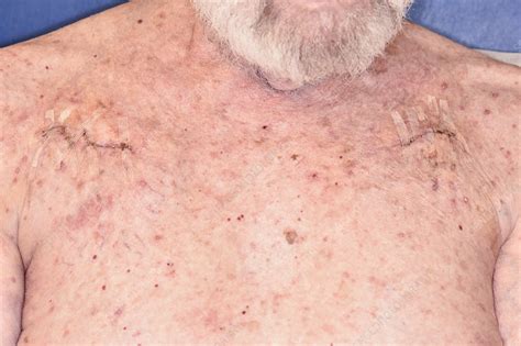 Pacemaker Insertion Scars Stock Image C047 3016 Science Photo Library