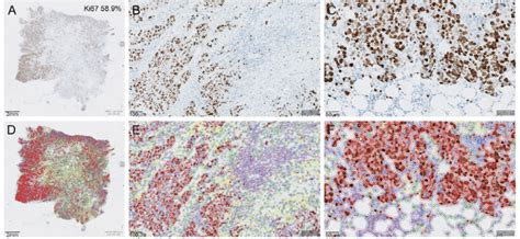 Automated Ki67 Scoring Algorithm In Qupath Illustrated By A Ki67 Download Scientific Diagram