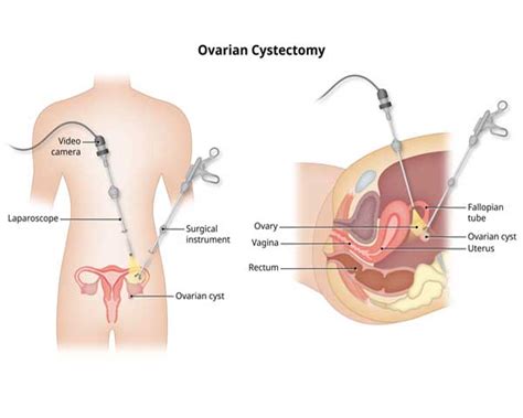 Fallopian Tube Cyst Ovarian Cysts Functional Or Neoplastic Benign Or