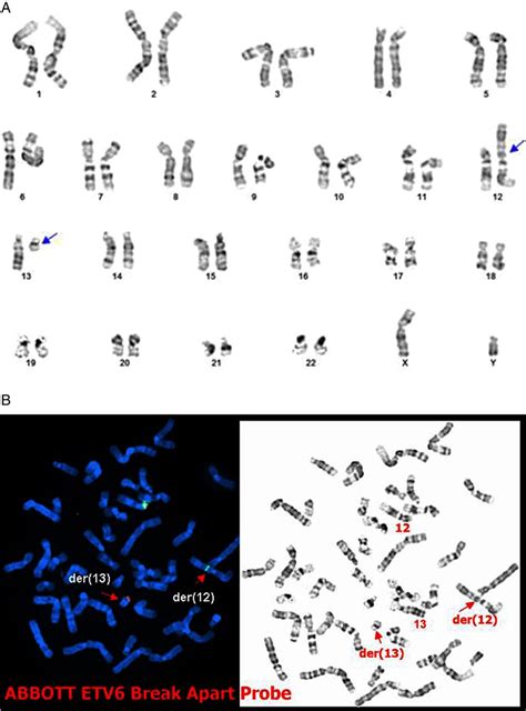 Double Hit Of Flt3 Gene In A Fatal Case Of Acute Myemonocytic Leukaemia Journal Of Clinical