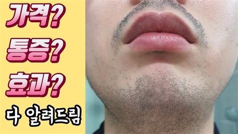 남자 수염 레이저 제모 통증 효과 가격 리얼 후기 Youtube