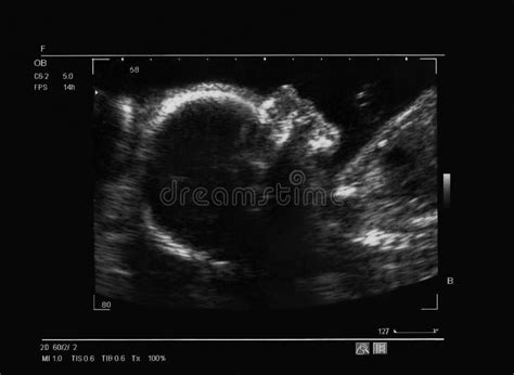 Ultra-som De Um Feto Em 26 Semanas Foto de Stock - Imagem de perfil ...