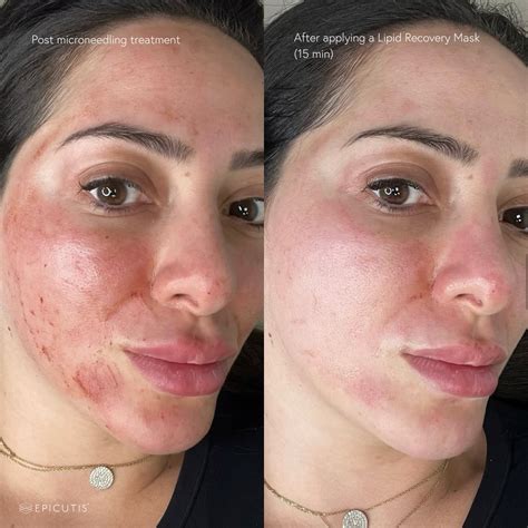 Epicutis Before And After Restore And Soothe Your Skin Post