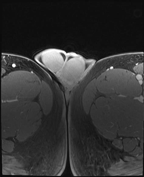 Normal Testis Mri