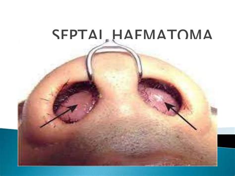 Septal Haematoma Pptx