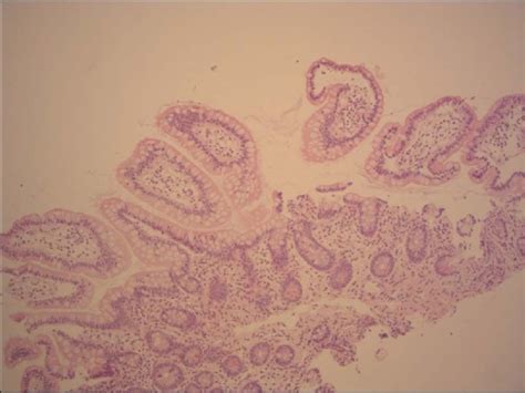 Normal Ileum Biopsy From The Patients Colonoscopy In 2021 Hematoxylin Download Scientific
