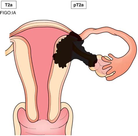 Uterine Sarcomas Leiomyosarcoma Endometrial Stromal Sarcoma Adenosarcoma Icd‐o‐3 C53 54