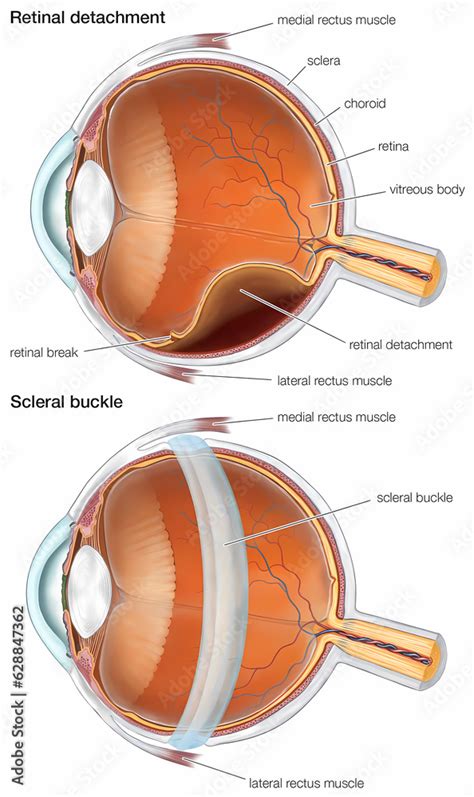Diagram Of A Scleral Buckle Used To Repair A Retinal Detachment Stock