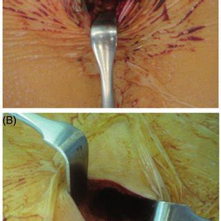 Intraoperative Photographs A Prior To Xiphoidectomy The Xiphoid Download Scientific Diagram