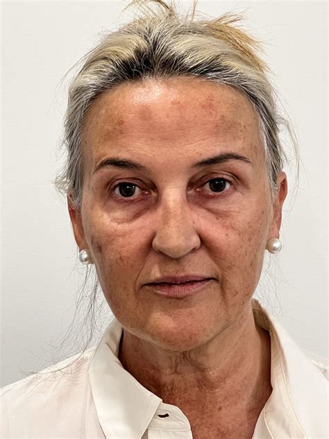 Hyperpigmentation Vs Hypopigmentation What Is The Difference Jeune