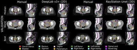 A Median Worst And Best Cases Regarding Average Dsc Per Patient For
