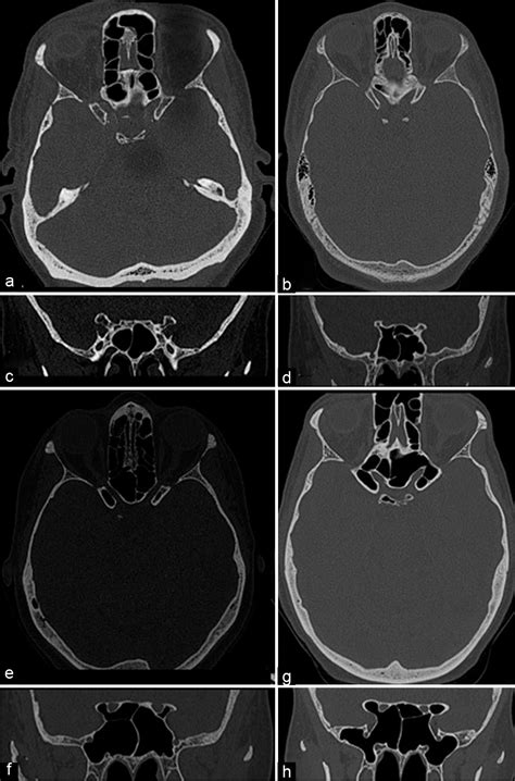 Surgical Neurology International