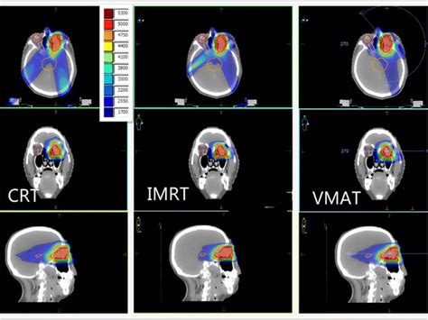 Dosimetric Advantage Of Volumetric Modulated Arc Therapy In The