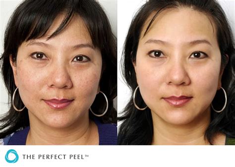 The Perfect Peel Skin Treatment At Oxfordshire Skin Clinic Lumiere